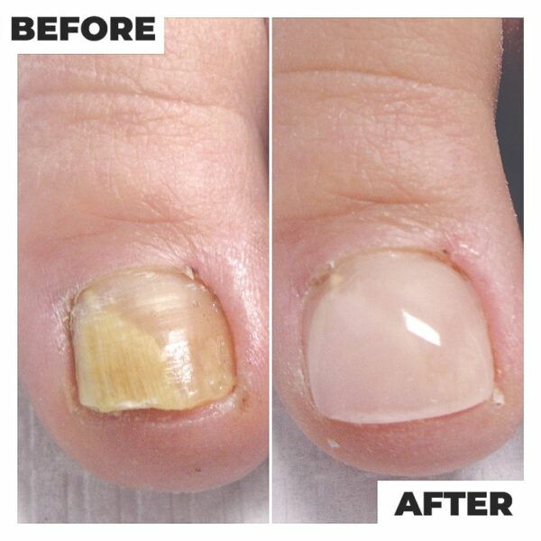 Keryflex Nail Restoration | Rose Bay Podiatry | Sydney